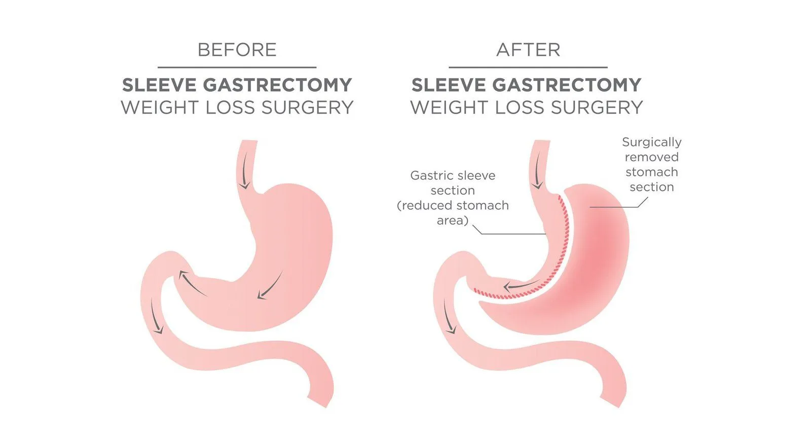 robotic gastric sleve - nihalanimd